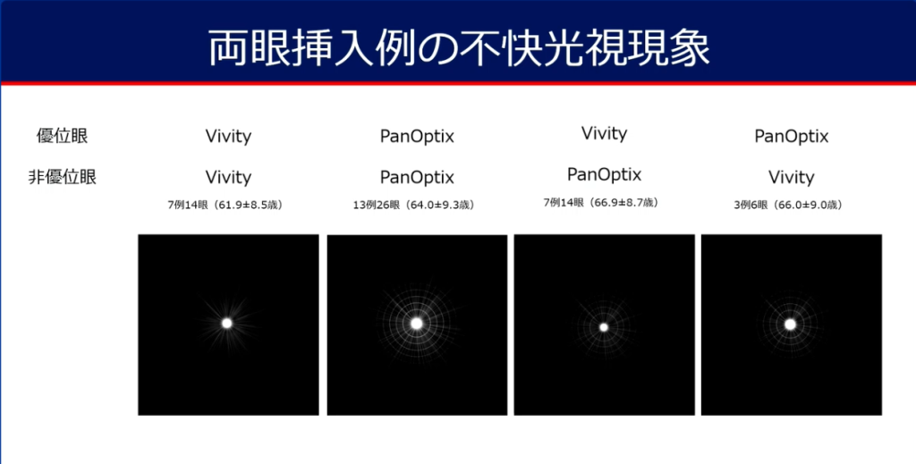 Mix＆Match法「PanOpitx,Vivity臨床データアップデート、適切なIOL選択」をみました - 眼科医のブログ