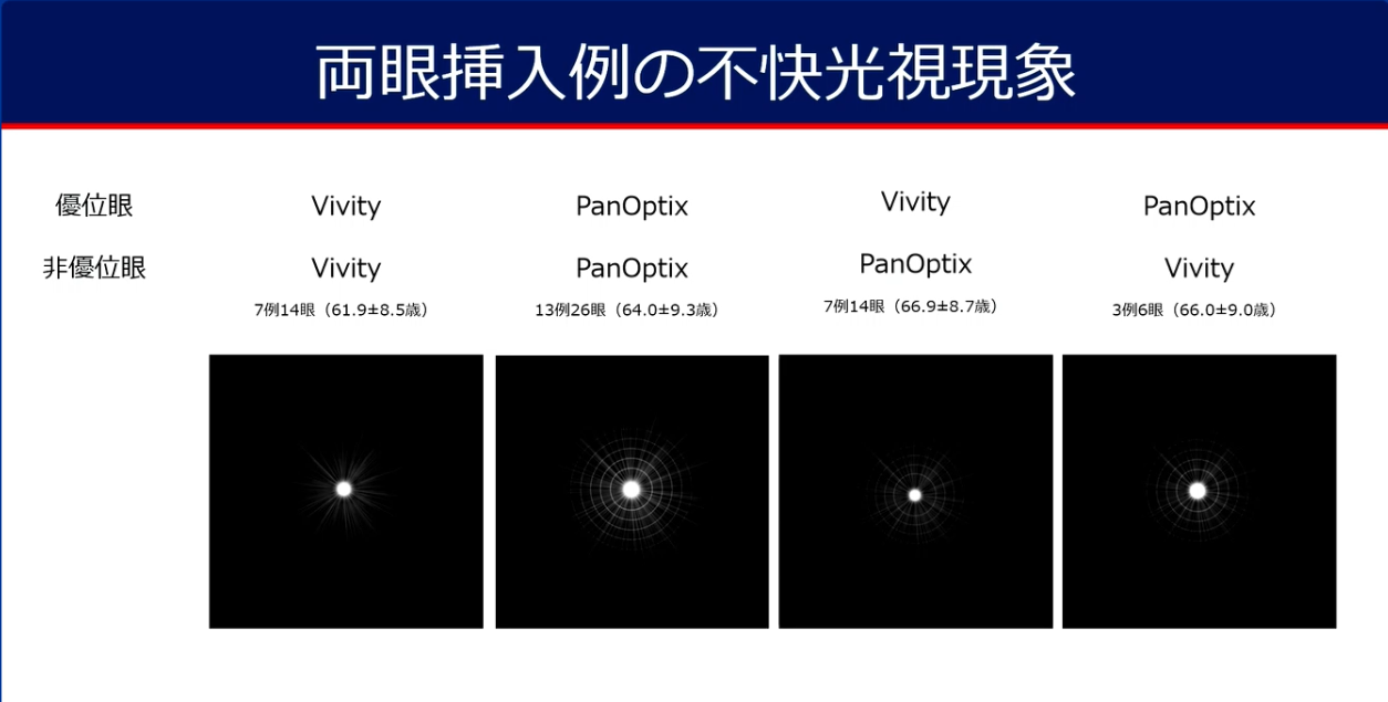 Mix＆Match法「PanOpitx,Vivity臨床データアップデート、適切なIOL選択」をみました - 眼科医のブログ